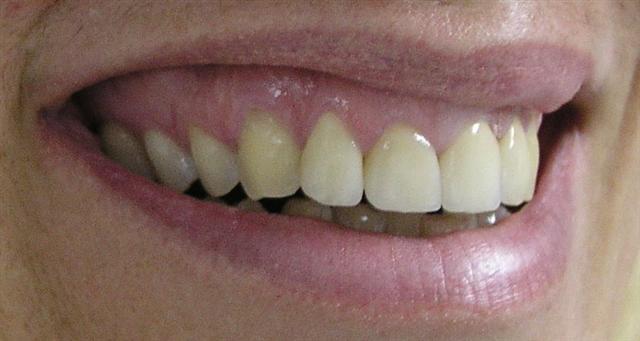 Cirkon keramičke krunice - dental centar mimica | mojkvart.hr