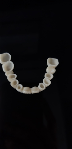 Cirkon keramička krunica - Dentalni laboratorij Ivana Rožić | mojkvart.hr